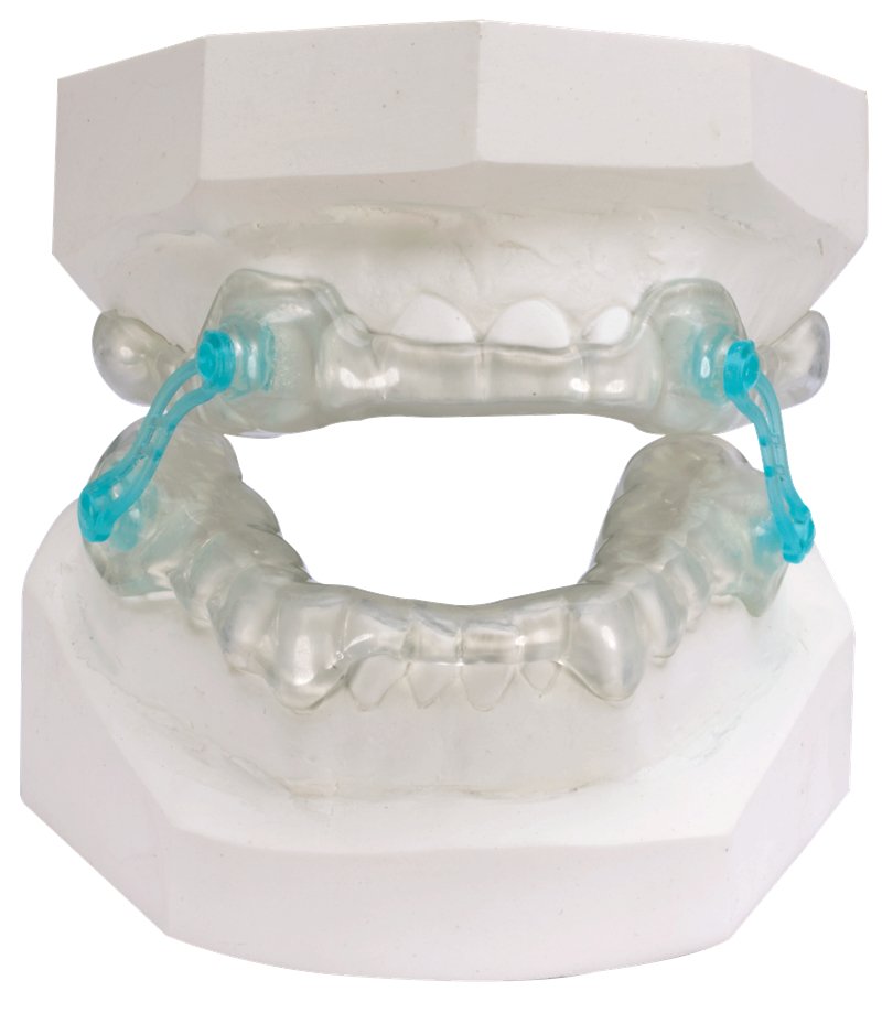 Silensor SL hilft Schnarchpatienten - 80 % Erfolgsbilanz